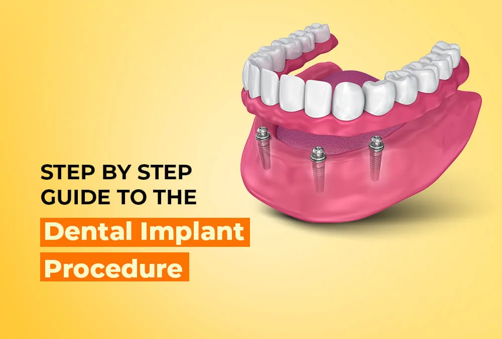 Step By Step Guide to the Dental Implant Procedure