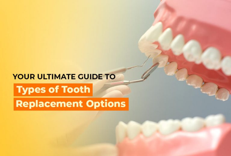 Your Ultimate Guide to Types of Tooth Replacement Options