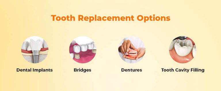 Your Ultimate Guide to Types of Tooth Replacement Options