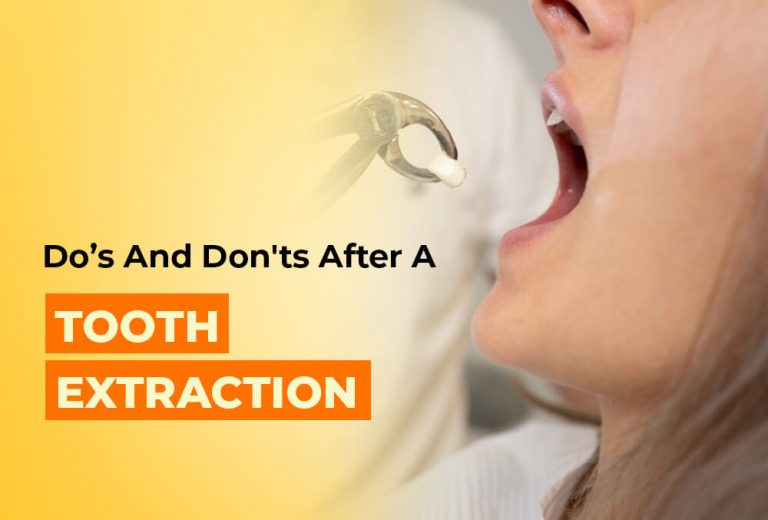 Do’s And Don'ts After A Tooth Extraction