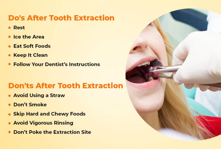 Do’s And Don'ts After A Tooth Extraction