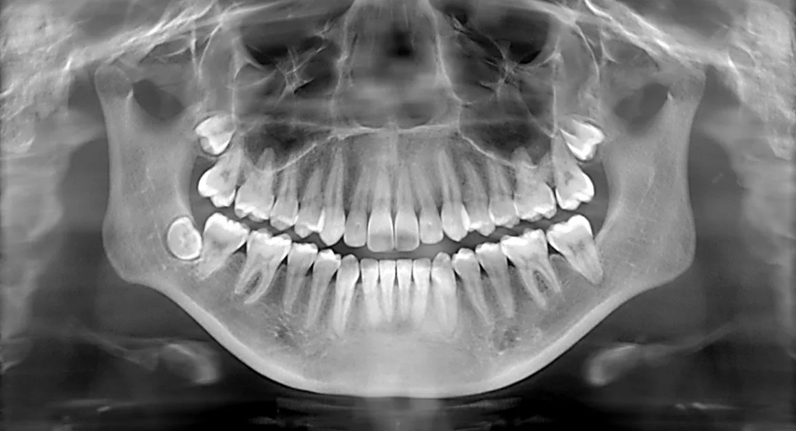 Root Canal Treatment in Hyderabad, India | Root Canal Near Me