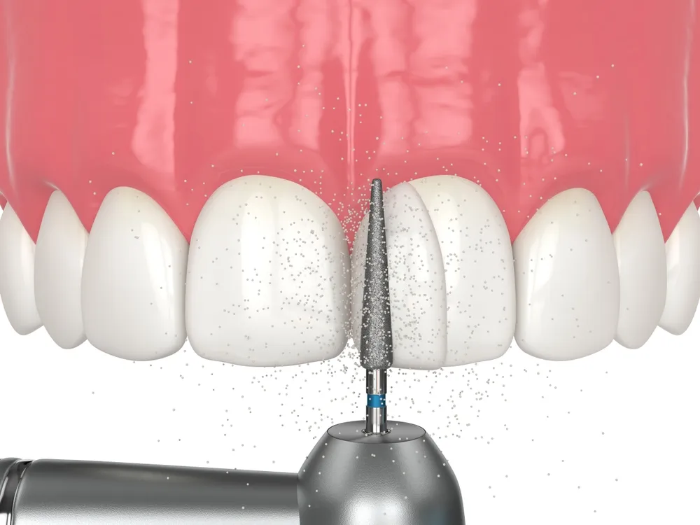 Root Canal Treatment in Hyderabad, India | Root Canal Near Me