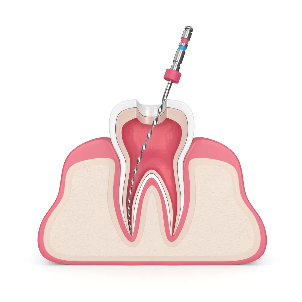 Root Canal Treatment in Hyderabad, India | Root Canal Near Me