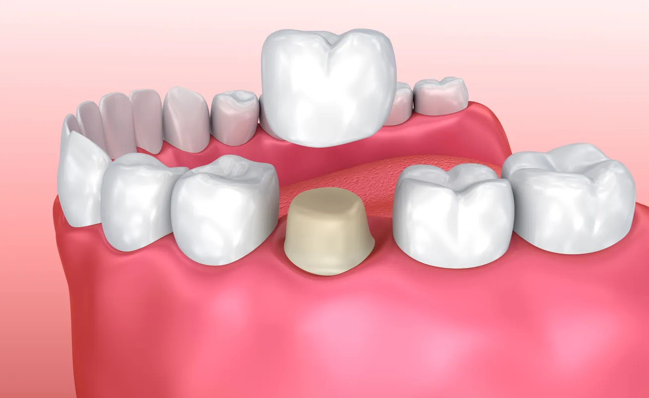 Root Canal Treatment in Hyderabad, India | Root Canal Near Me