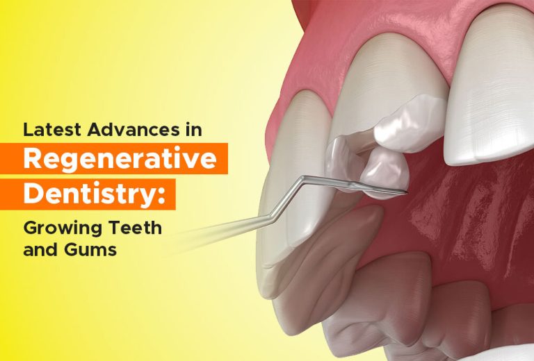 Dental Fillings in Hyderabad - National Dental Care