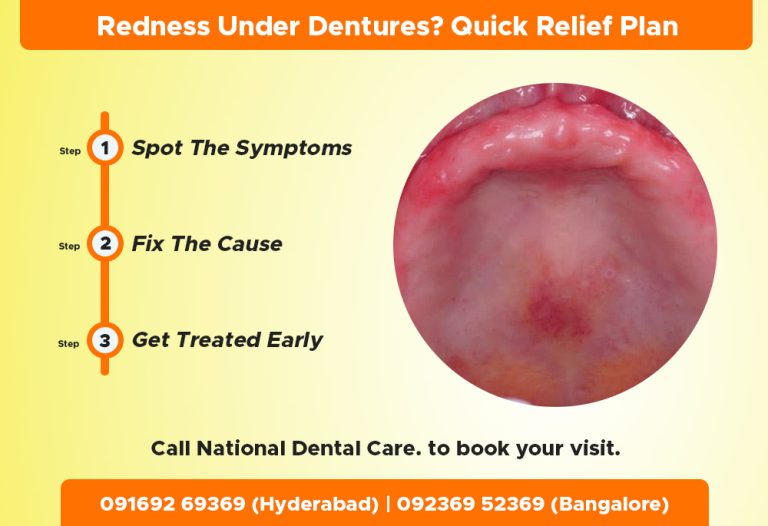 Denture Stomatitis - Symptoms, Treatment, and Prevention